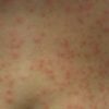 Hot Tub Rash Cure & Pictures
